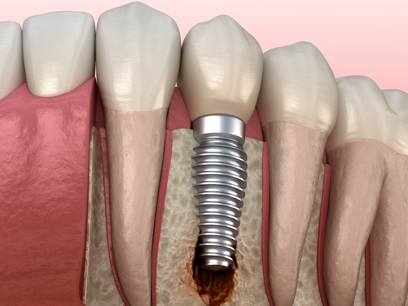 Failed Dental Implants: Warning Signs and Prevention