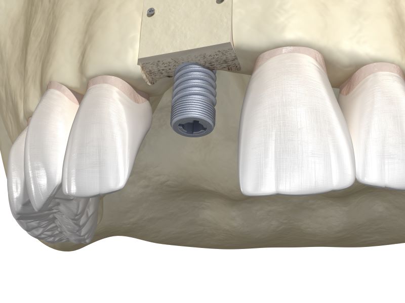 What Should You Know About Bone Grafting Before Dental Implants?