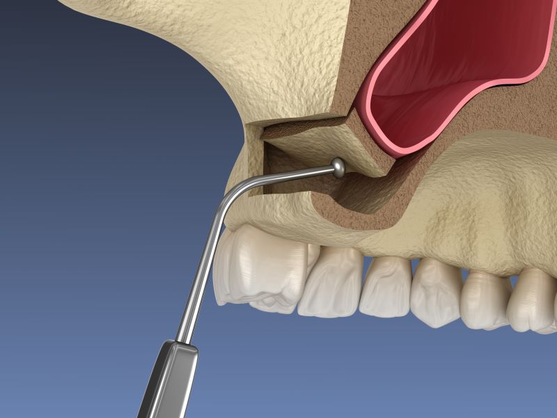 Understanding Sinus Lifts: A Key Step Before Dental Implants